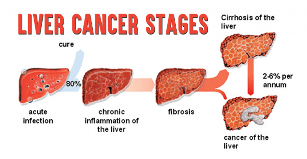 Cancer of the liver Hepatocellular Carcinoma (HCC) – Dr Faisal Dar