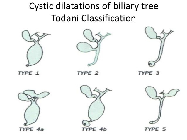 CHOLEDOCHAL CYST IN CHILDREN - PKLI&RC