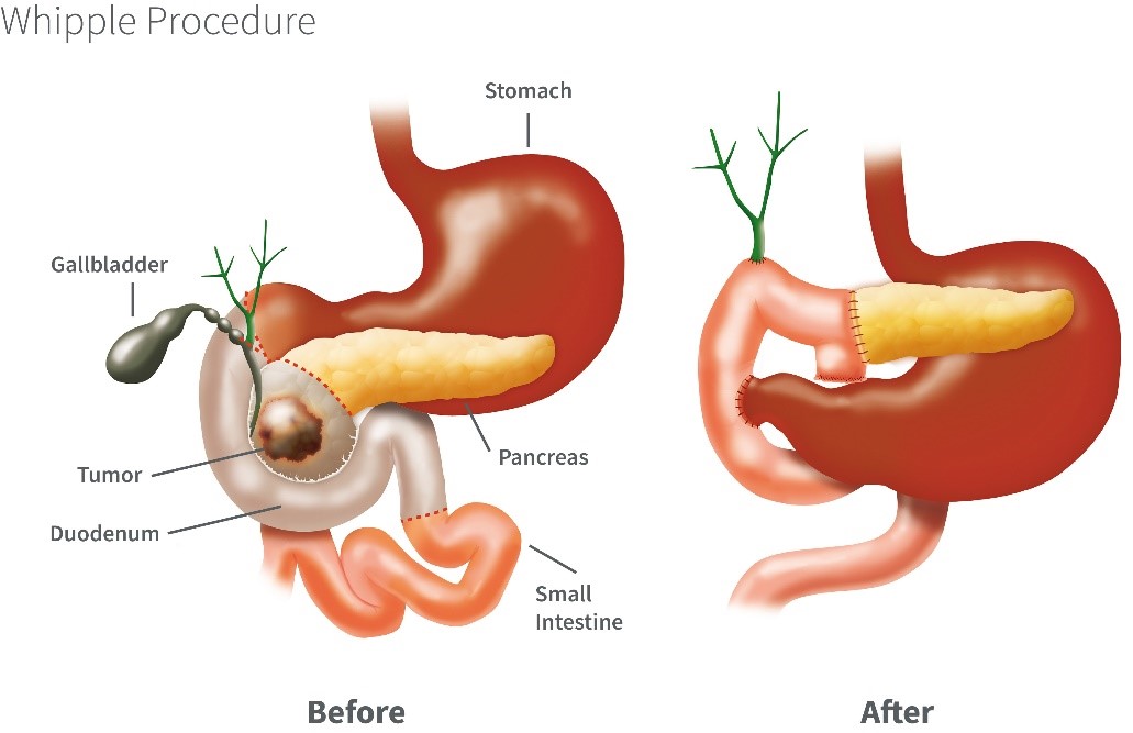 Pancreatic Resection For The Surgical Treatment Of Cancer Dr Faisal Dar