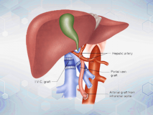 Auxiliary liver transplantation for acute liver failure in children ...